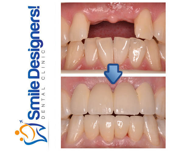 Solutions économiques pour remplacer les dents manquantes